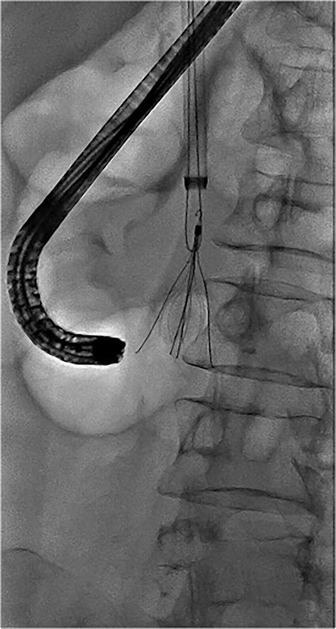 The Use Of Interventional Radiology And Endoscopic Techniques In The Download Scientific