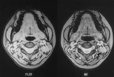 Tuberculous Lymphadenitis The Left Posterior Cervical Lymph Nodes Download Scientific Diagram