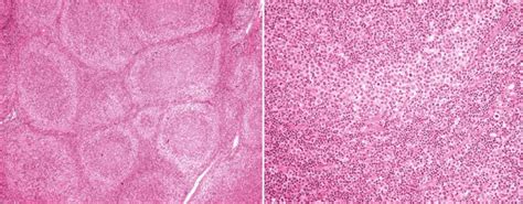 A Lymph Node Follicular Lymphoma With Marginal Zone Differentiation