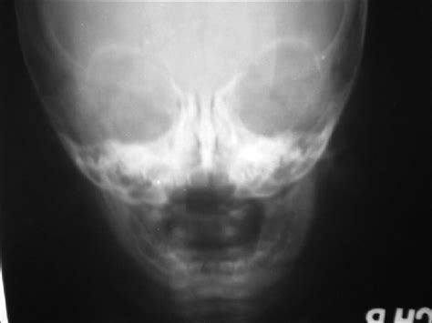 X Ray Of The Skull Showing Diffuse Thickening And Increased Density Of Download Scientific