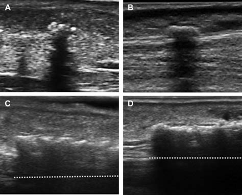 Subcutaneous Calcifications In Legs With Chronic Venous Diseases