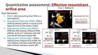 Rheumatic Heart Disease Clinical And Echocardiographic Overview Pptx