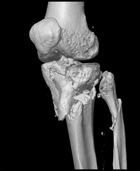 Radiopaedia Case Complex Proximal Tibial And Fibular Fractures Id