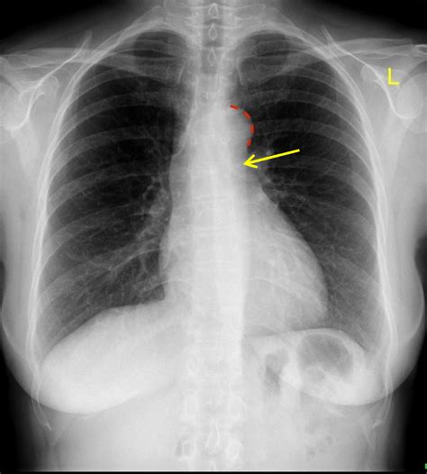Chest X Ray Interpretation