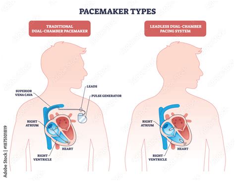 Pacemaker Types Overview Compares Traditional Dual Chamber And Leadless