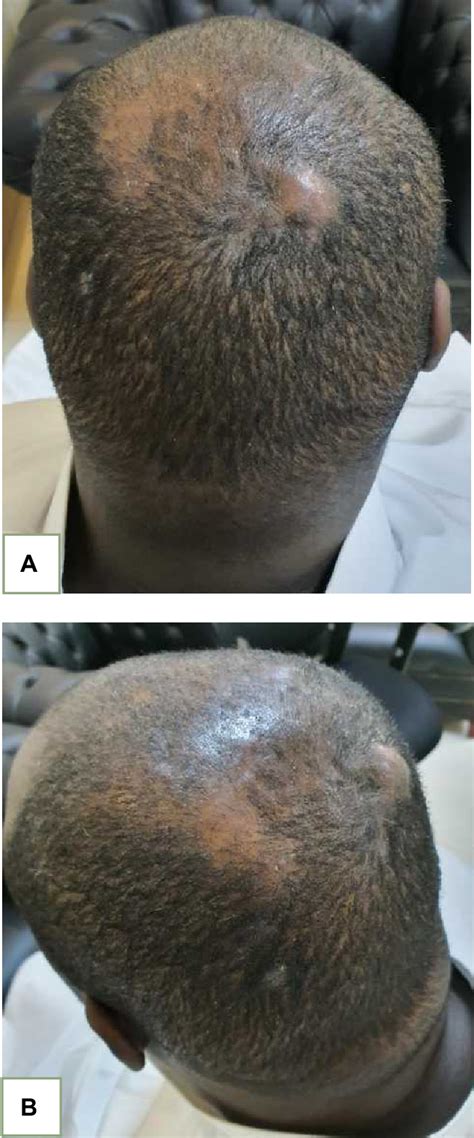 Figure 1 From Recalcitrant Dissecting Cellulitis Of The Scalp Treated Successfully With