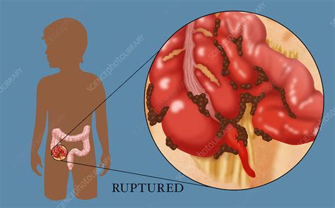 Ruptured Appendix Illustration Stock Image C027 6233 Science Photo Library