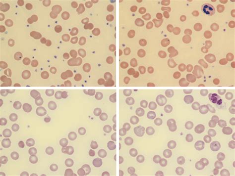 American Journal Of Hematology Blood Research Journal Wiley Online