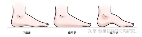 儿童鞋垫选择误区：穿有足弓承托的鞋垫会影响足部发育？ 知乎