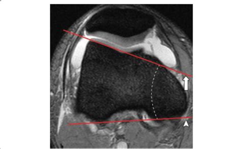 Axial Fat Saturated T2 Weighted Mr Image For The Assessment Of The Download Scientific Diagram
