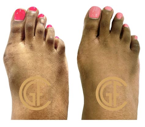 Hammer Toe Surgery Before And After Photos In New York