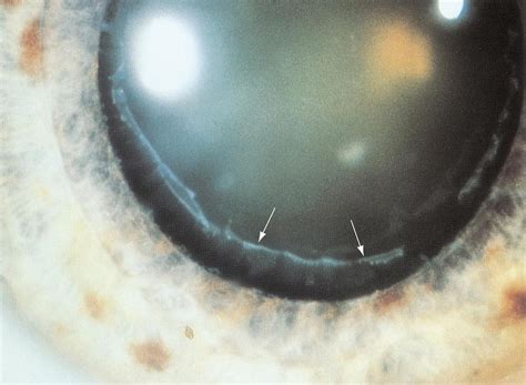 What Is Glaucoma Causes Types Symptoms Of Glaucoma
