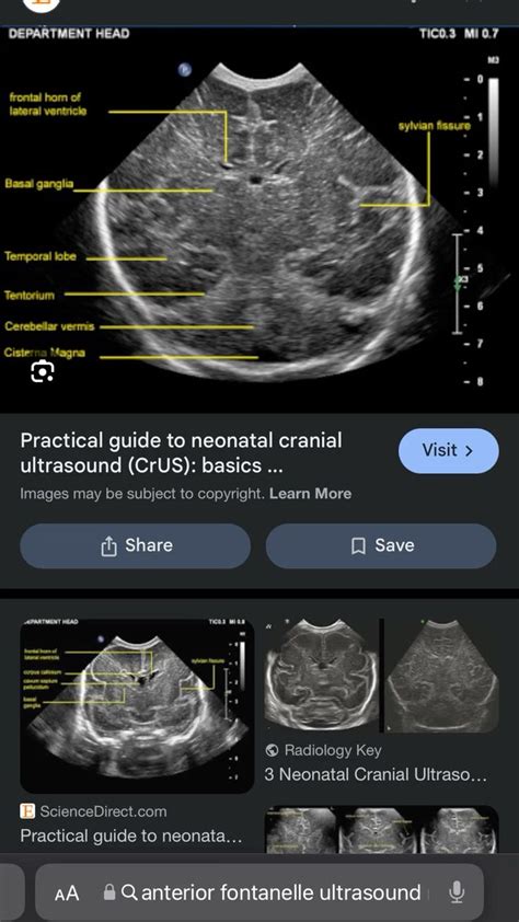Benign Enlargement Of Subarachnoid Space In Infancy A Review With Emphasis On Diagnostic Work