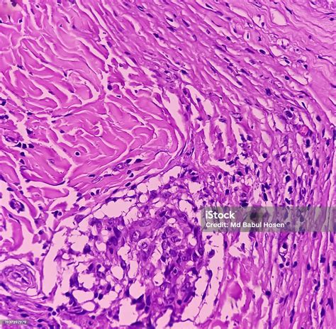 Thyroid Cancer Microscopic Image Of Follicular Neoplasm Malignant Neoplasm Of Atypical Thyroid