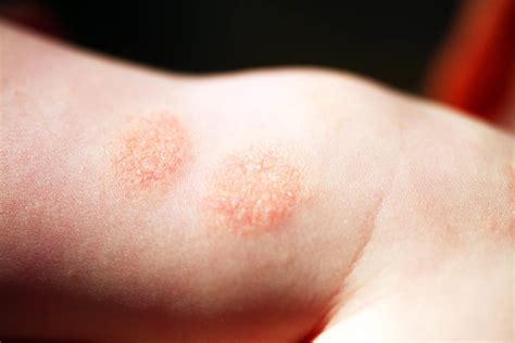 Nummular Dermatitis Symptoms Pictures And Treatment