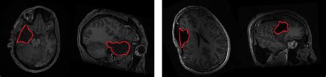 Figure 1 From A Deep Learning Framework To Localize The Epileptogenic Zone From Dynamic