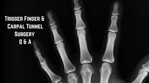 Trigger Finger Radiograph