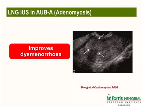 Mirena An Emerging Tool In Managing Abnormal Uterine Bleeding Pptx