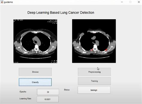 Lung Cancer Detection Using Deep Learning