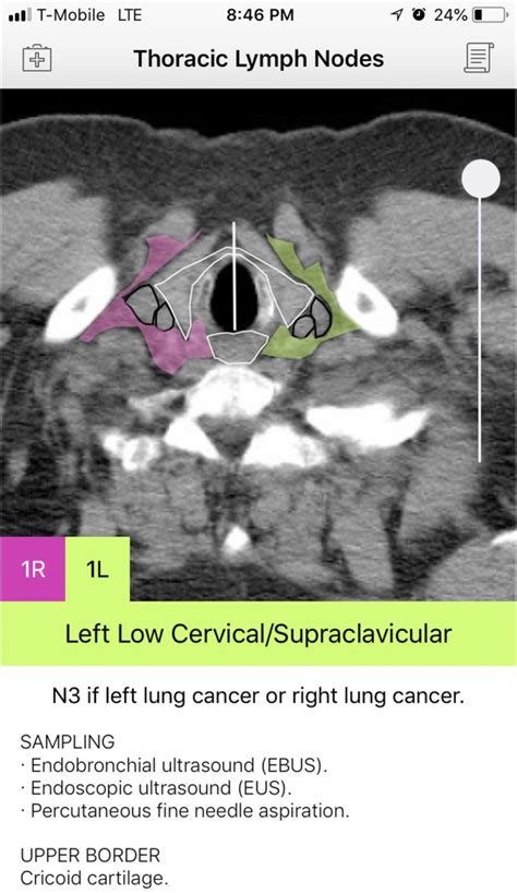 Thoracic Lymph Node Map App Review Pmc