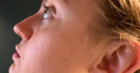 What Is A Preauricular Pit And Are They Dangerous The Hole In My Head People Mistake For A