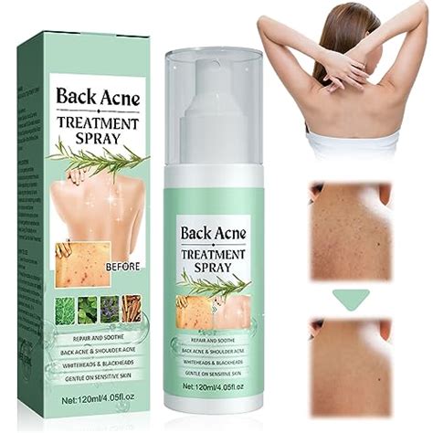 Crema Para Granos En La Espalda