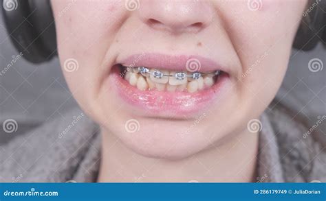 Girl Touching Her Metal Braces With Tongue Close View Of The Mouth With Braces Stock Video