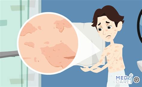 Lupus Eritematoso Sistemico Les Med4care