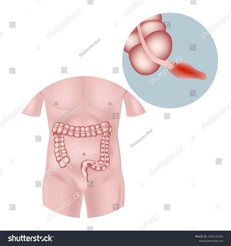 Inflammation Appendix Torso Intestines Medical Poster Stock Vector