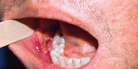 Utafiti Ngono Ya Mdomo Ni Hatari Udaku Special