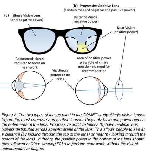 Myopia Lens Power Is Positive Or Negative At Oliver Lake Blog