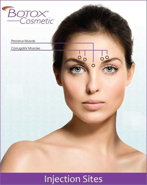 The Ultimate Guide To Botox Injection Points Understanding The Face Diagram