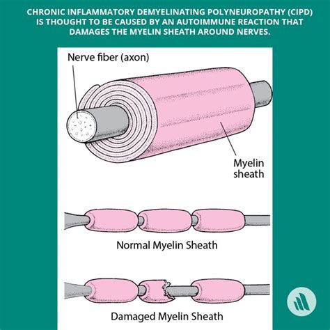 Chronic Inflammatory Demyelinating Polyneuropathy Cidp Is An Immune Mediated Polyneuropathy