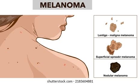 Three Types Melanoma Stock Illustration Stock Illustration Shutterstock