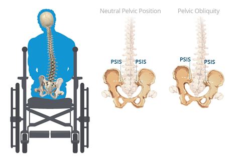 Pelvic Obliquity Definition Symptoms And Solutions