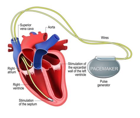 Cardiac Physiological Pacing For Pacemaker Cpp Wwmg Blog