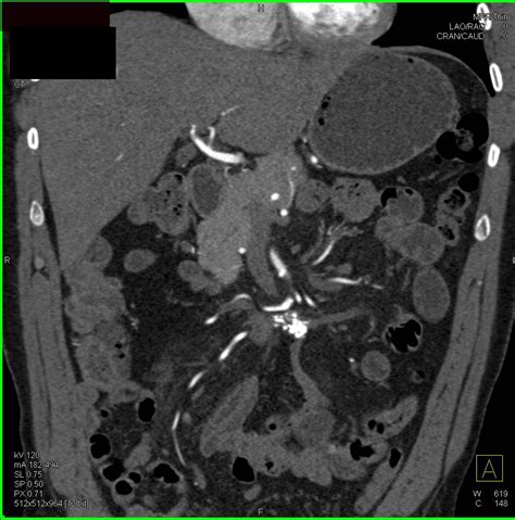 Sclerosing Mesenteritis With Calcified Mesenteric Mass Small Bowel