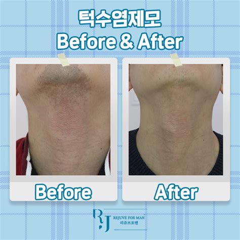 서면남성제모 턱 수염 레이저제모 전후 후기 네이버 블로그