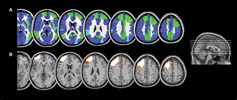 Voxel Based Morphometry Current Perspectives Nan