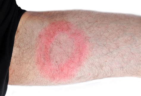 Lyme Disease Rash Identification Diagnosis And Treatment The Chupitos
