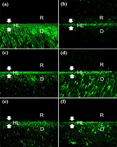 Evaluation Of The Interaction Of Chlorhexidine And Mdp And Its Effects