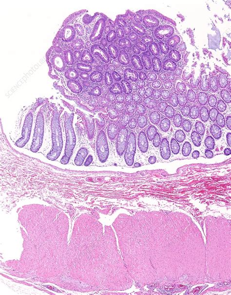 Tubular Colon Polyp Light Micrograph Stock Image C038 9541 Science Photo Library