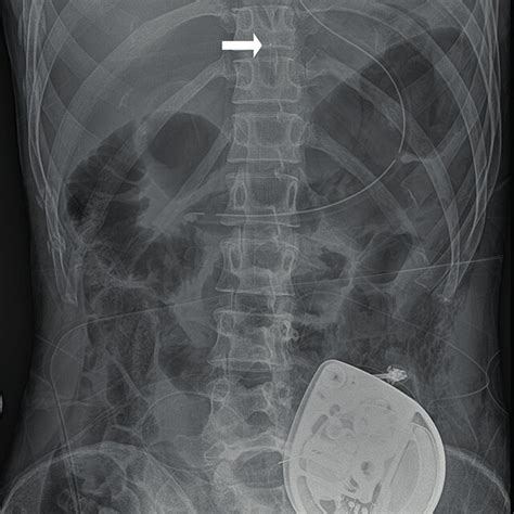An Abdomen Plain Radiograph Shows Implanted Intrathecal Baclofen Pump