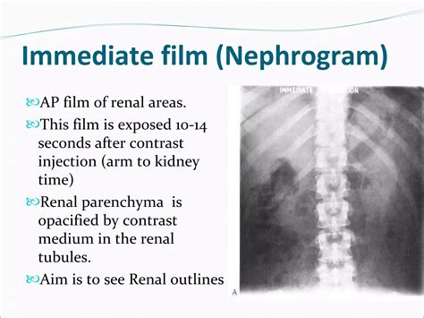 Intravenous Urography Ivu By Dr Bishnu Khatiwada Conventional Ivu