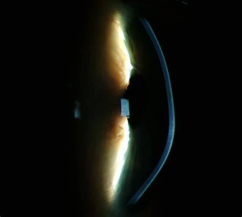 Keratoconus May Be Caused By Eye Rubbing But That Isnt All