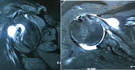 Figure 1 From Clinical And Radiological Outcomes Of Arthroscopic Subcoracoid Decompression For
