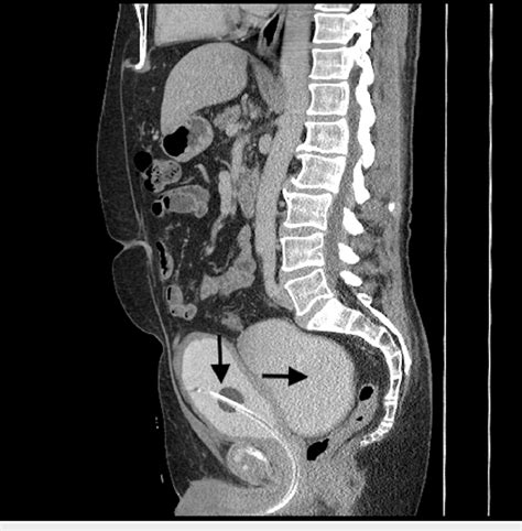 Sagittal View Of Ct Abdomen And Pelvis With Contrast Showing A Large