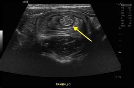 Intussusception Ultrasound Radiology