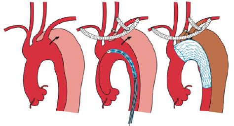 Carotid Subclavian Transposition