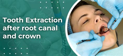 Tooth Extraction After Root Canal And Crown Neo Dental Care